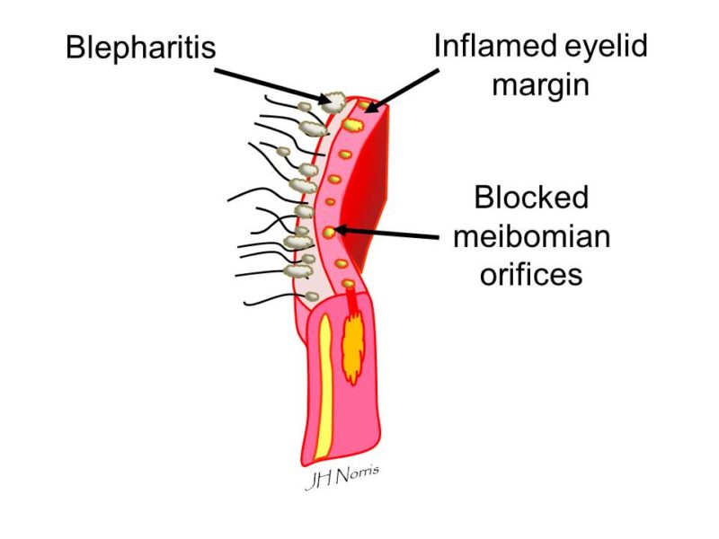 Blepharitis - Jonathan Norris
