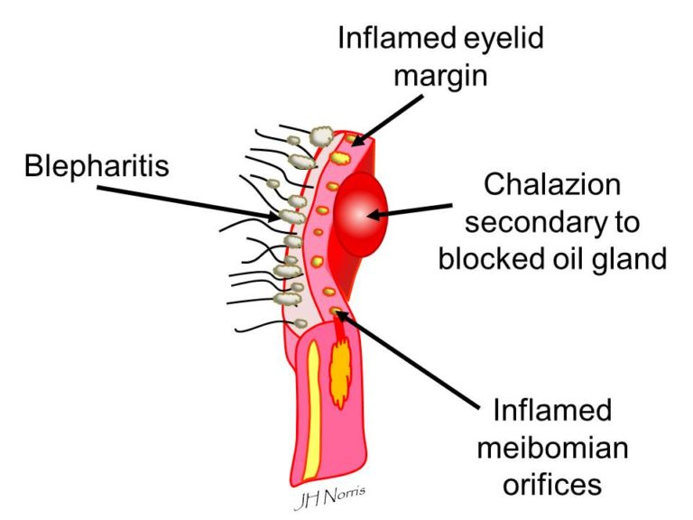 Chalazion (eyelid cysts) - Jonathan Norris