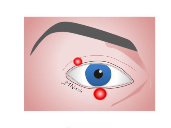 Chalazion (eyelid cysts) - Jonathan Norris