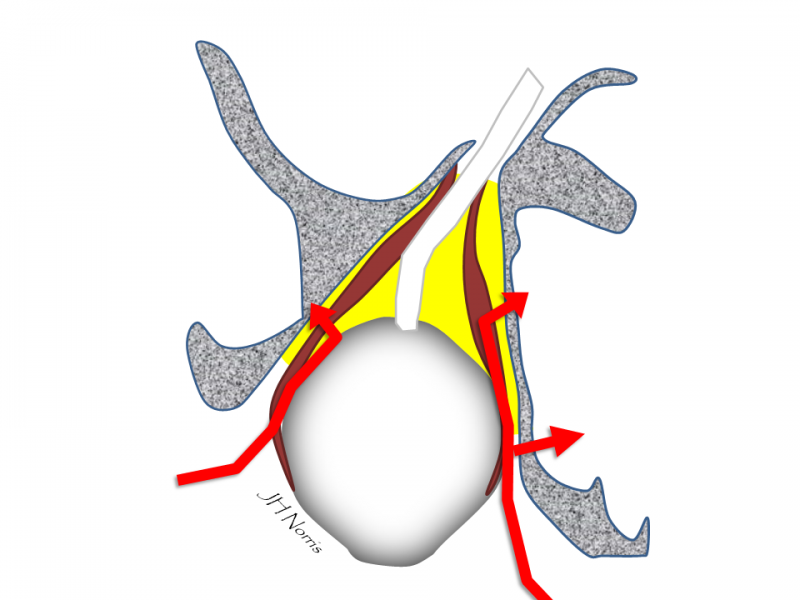Orbital decompression surgery - Jonathan Norris