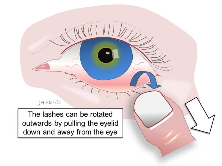 Entropion - Jonathan Norris