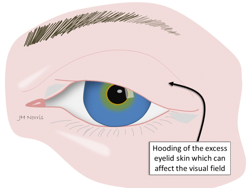 Upper eyelid blepharoplasty - Jonathan Norris