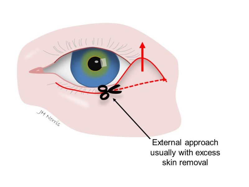 'Eye bag' surgery (lower eyelid blepharoplasty) - Jonathan Norris